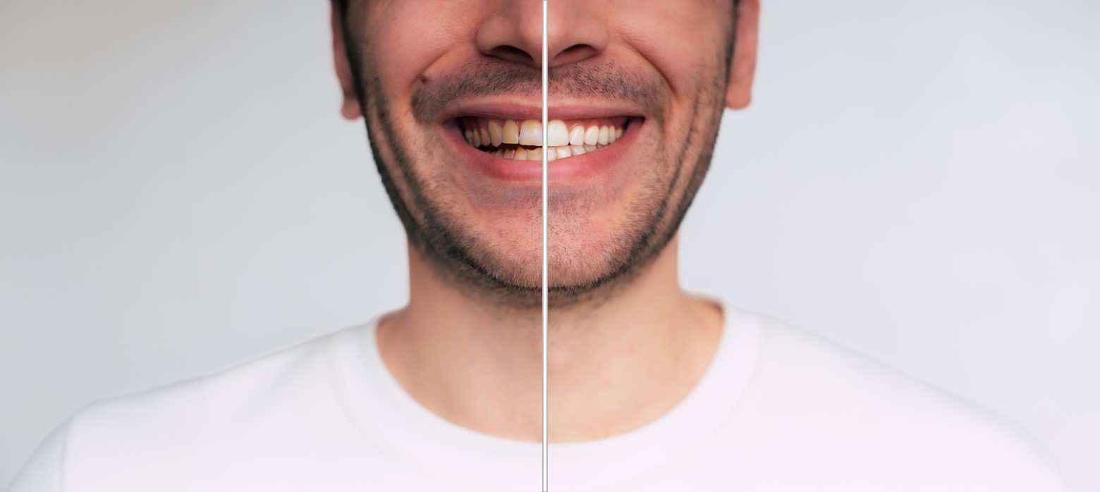 How to Achieve a Brighter Smile: A Comprehensive Guide to Teeth ...